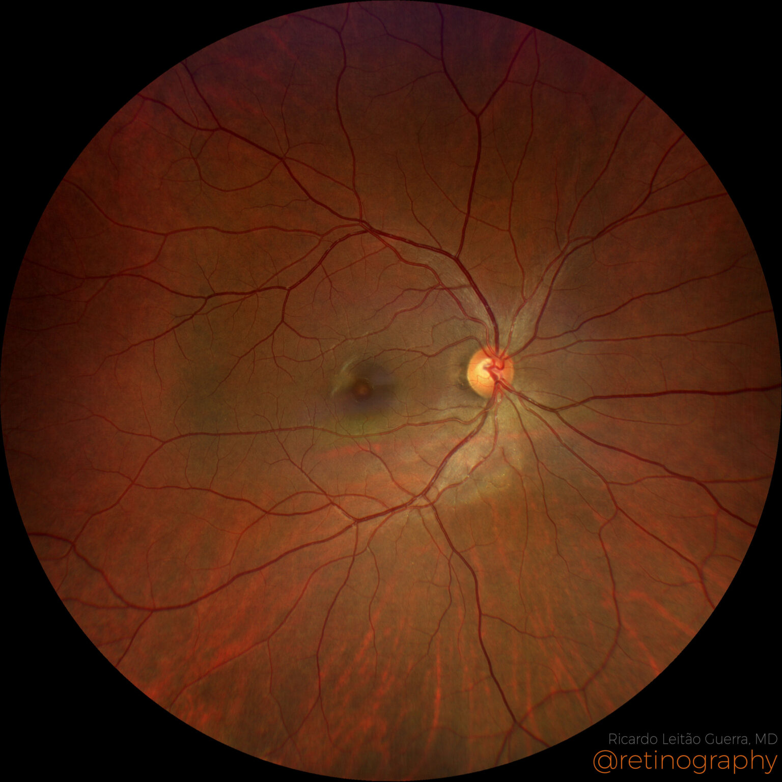 Central Serous Chorioretinopathy – Retinography