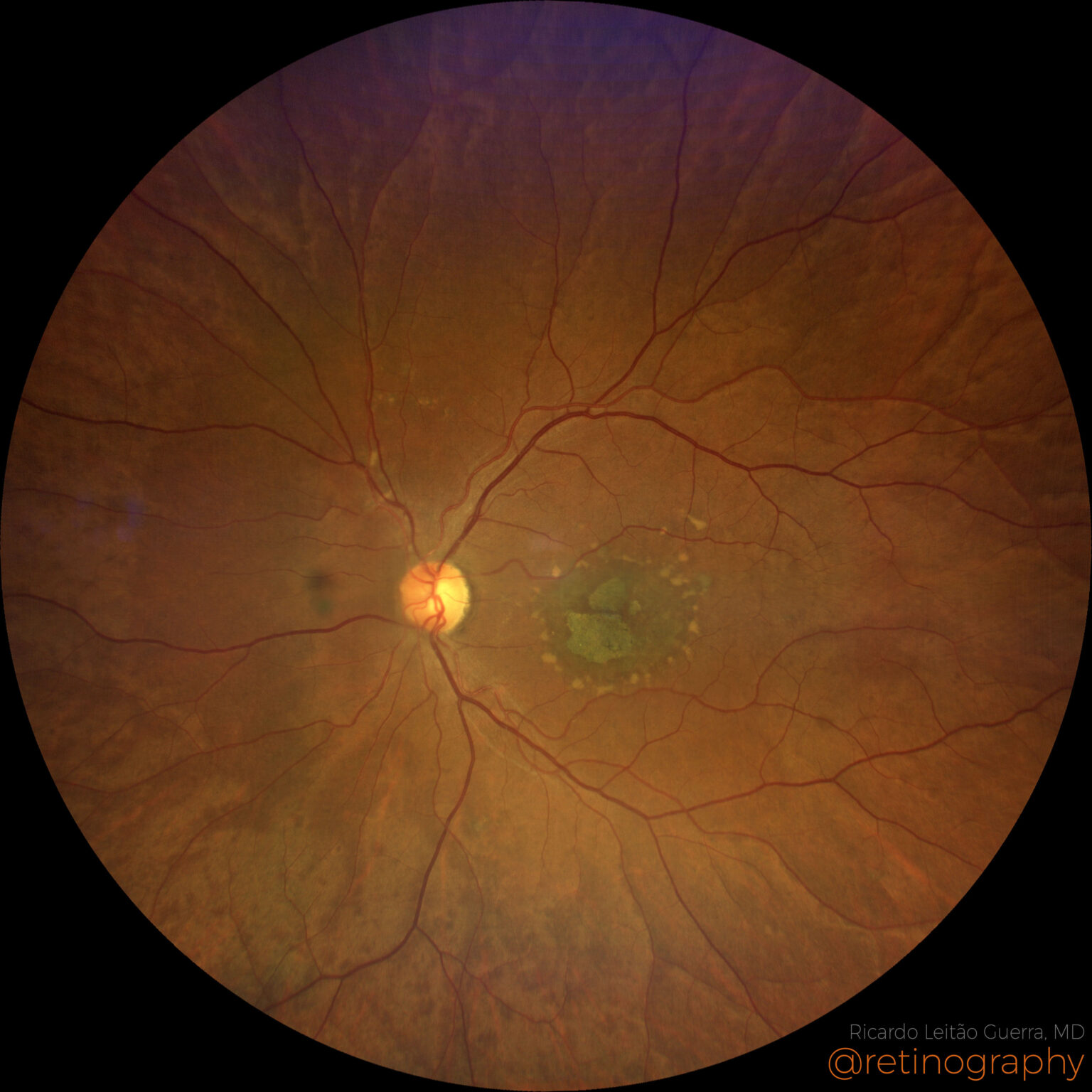 Stargardt disease – Retinography
