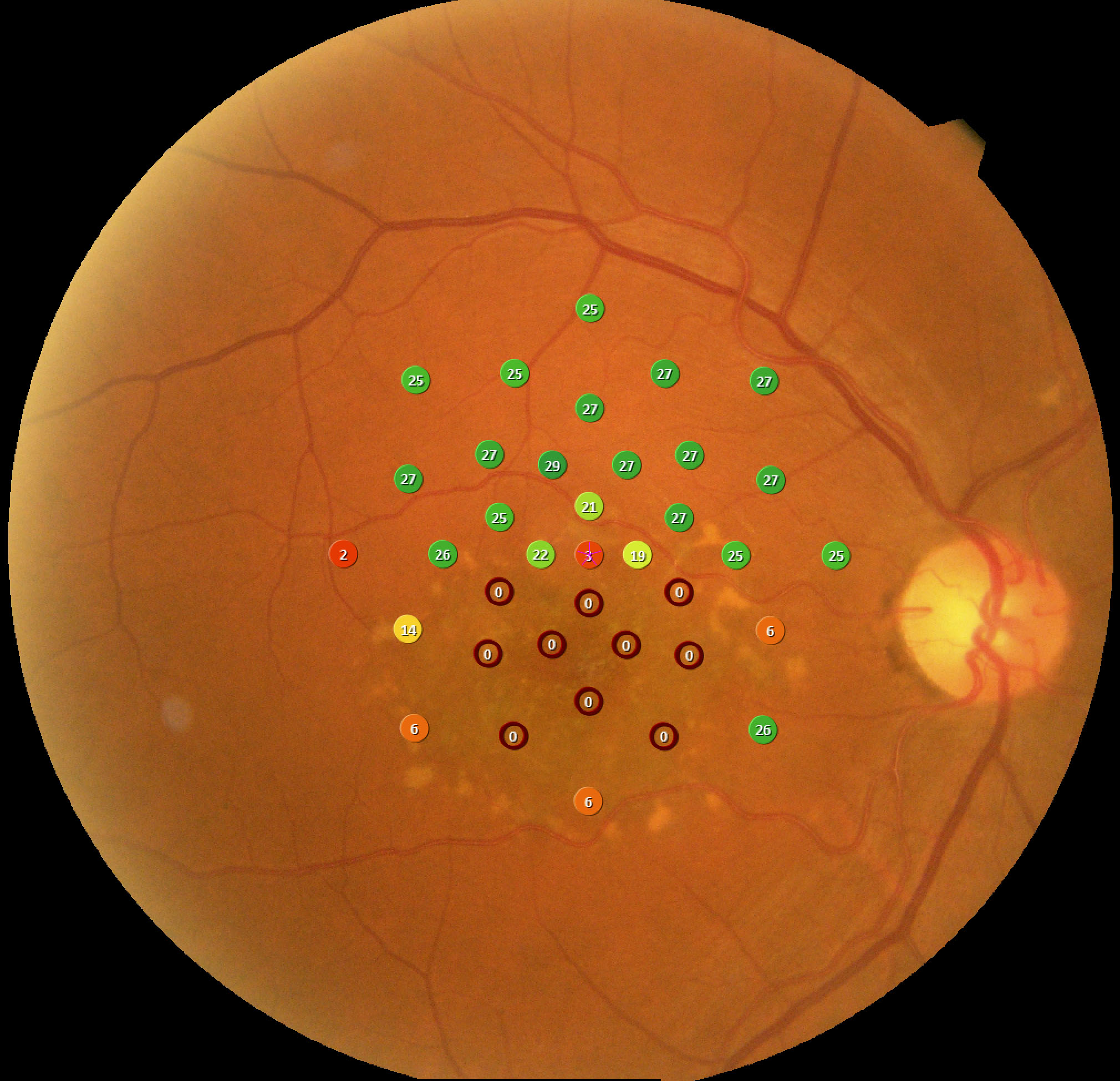 Stargardt disease – Retinography
