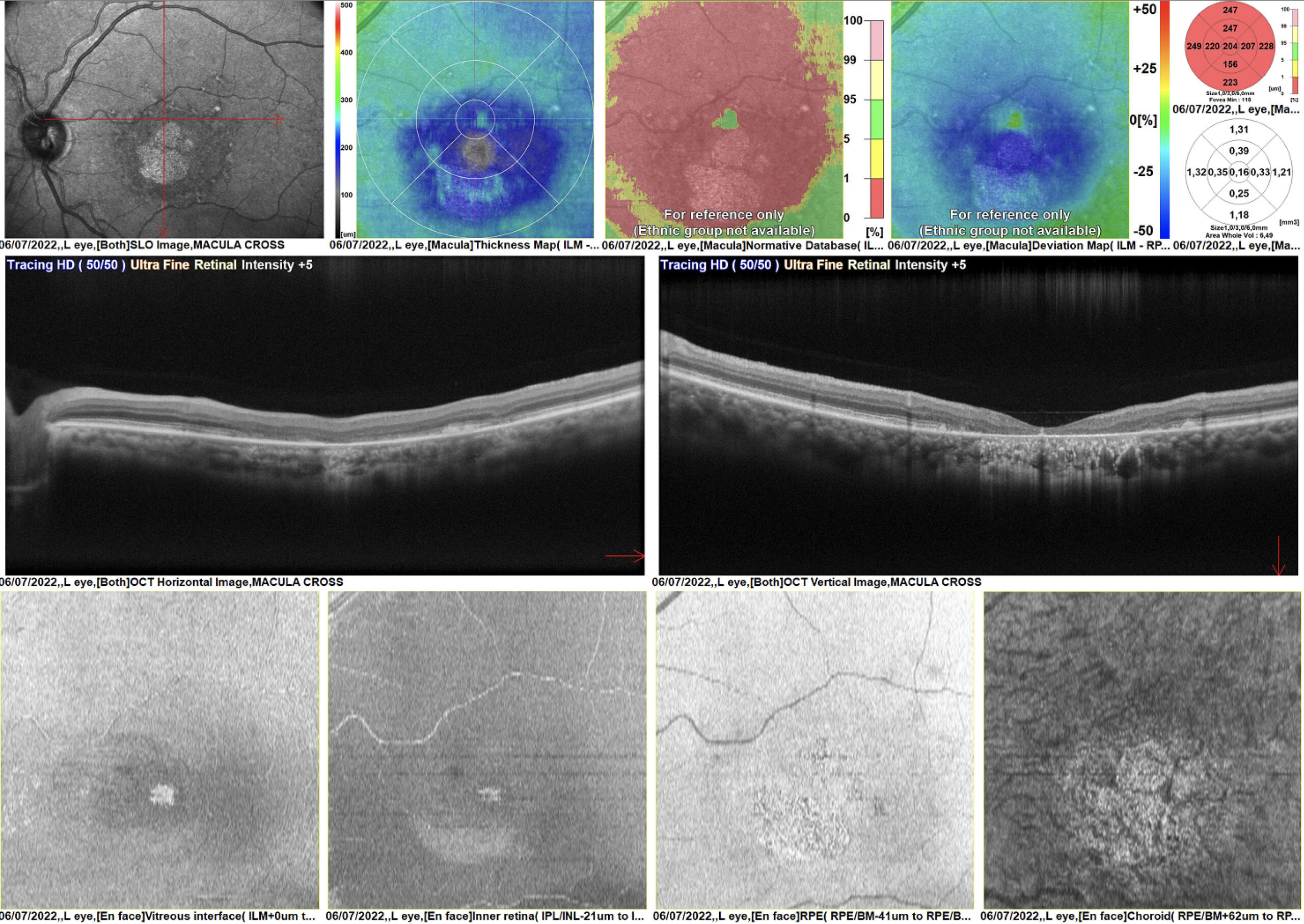 Stargardt disease – Retinography