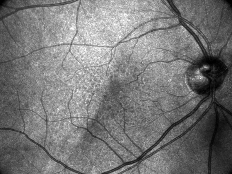 Pseudodrusen – Retinography