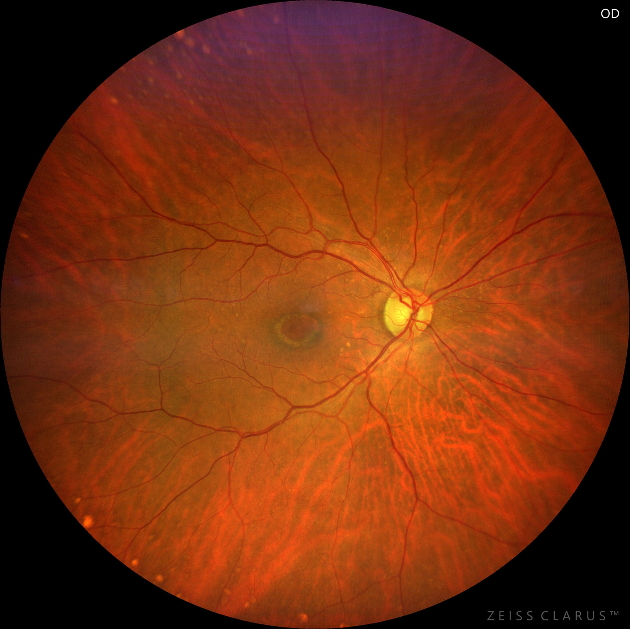 Bull’s eye maculopathy related to antimalarial drugs – Retinography