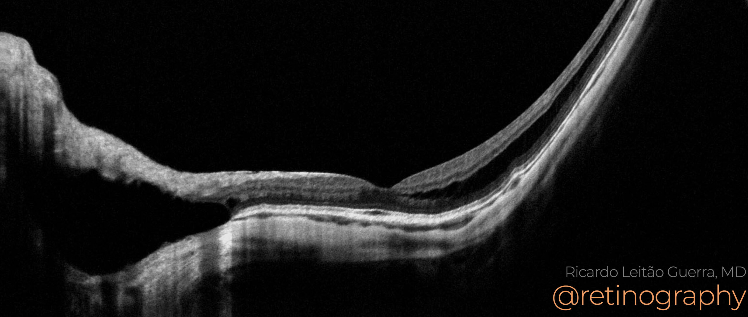 Peripapillary intrachoroidal cavitation – Retinography
