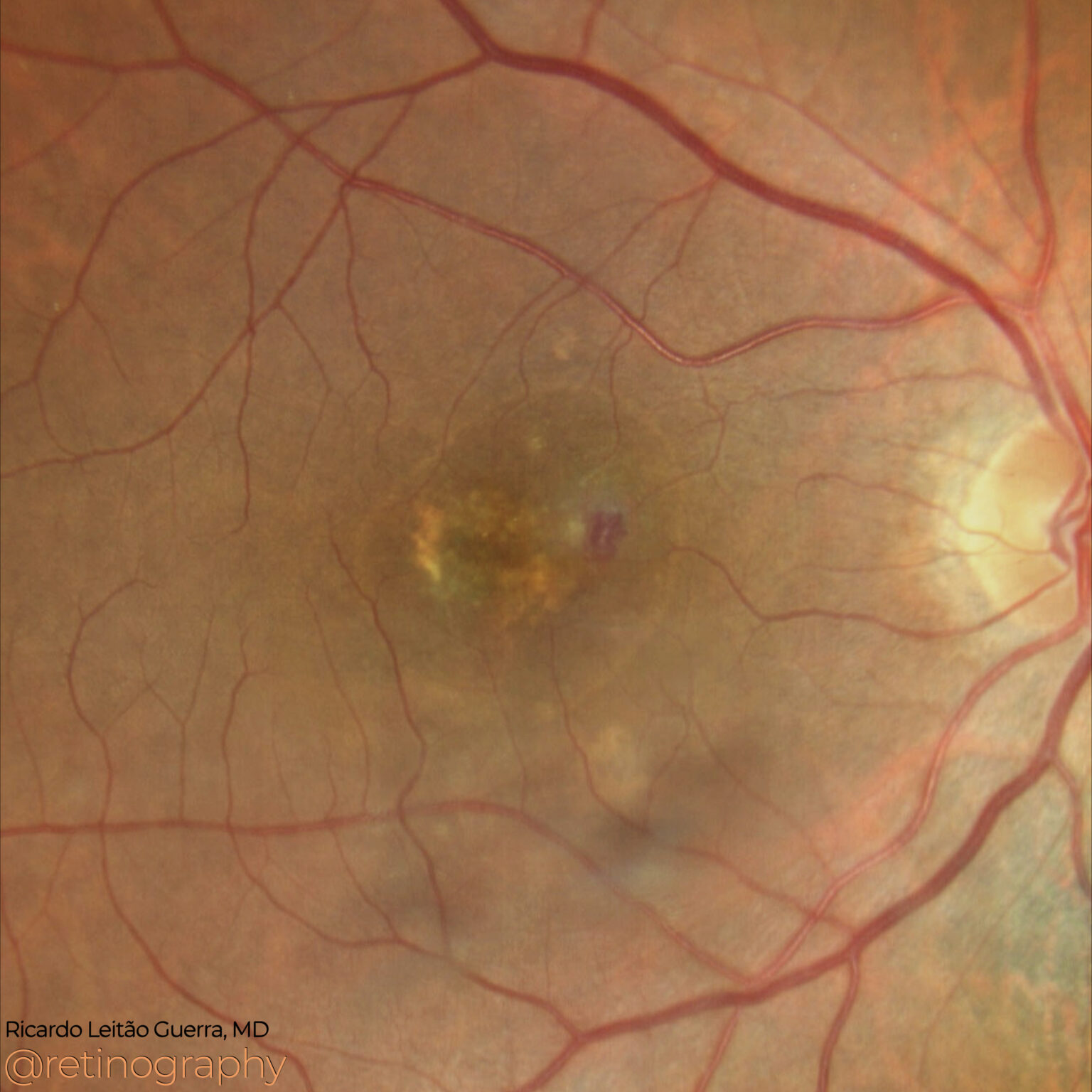 Polypoidal choroidal vasculopathy, – Retinography