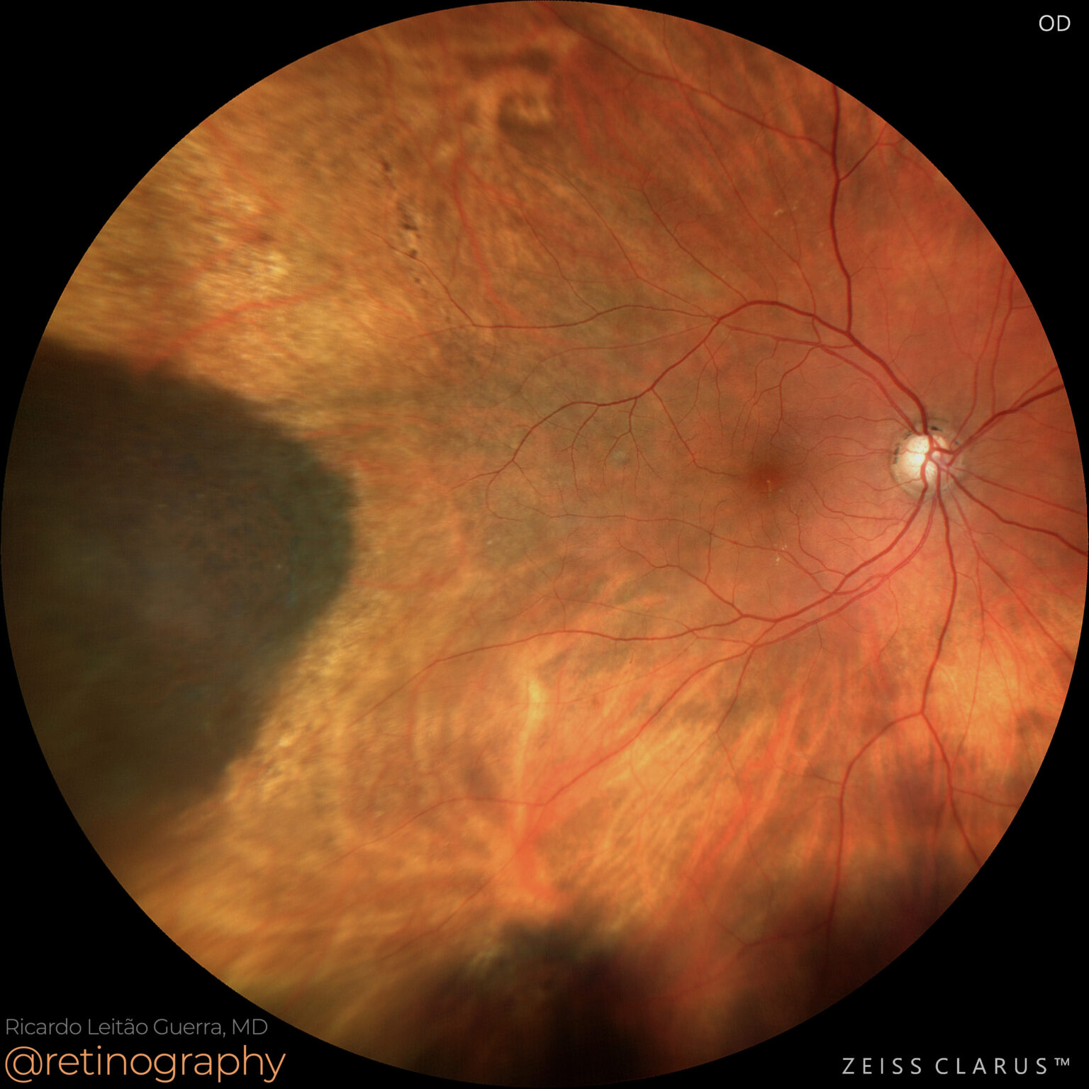 Choroidal melanoma after brachytherapy – Retinography