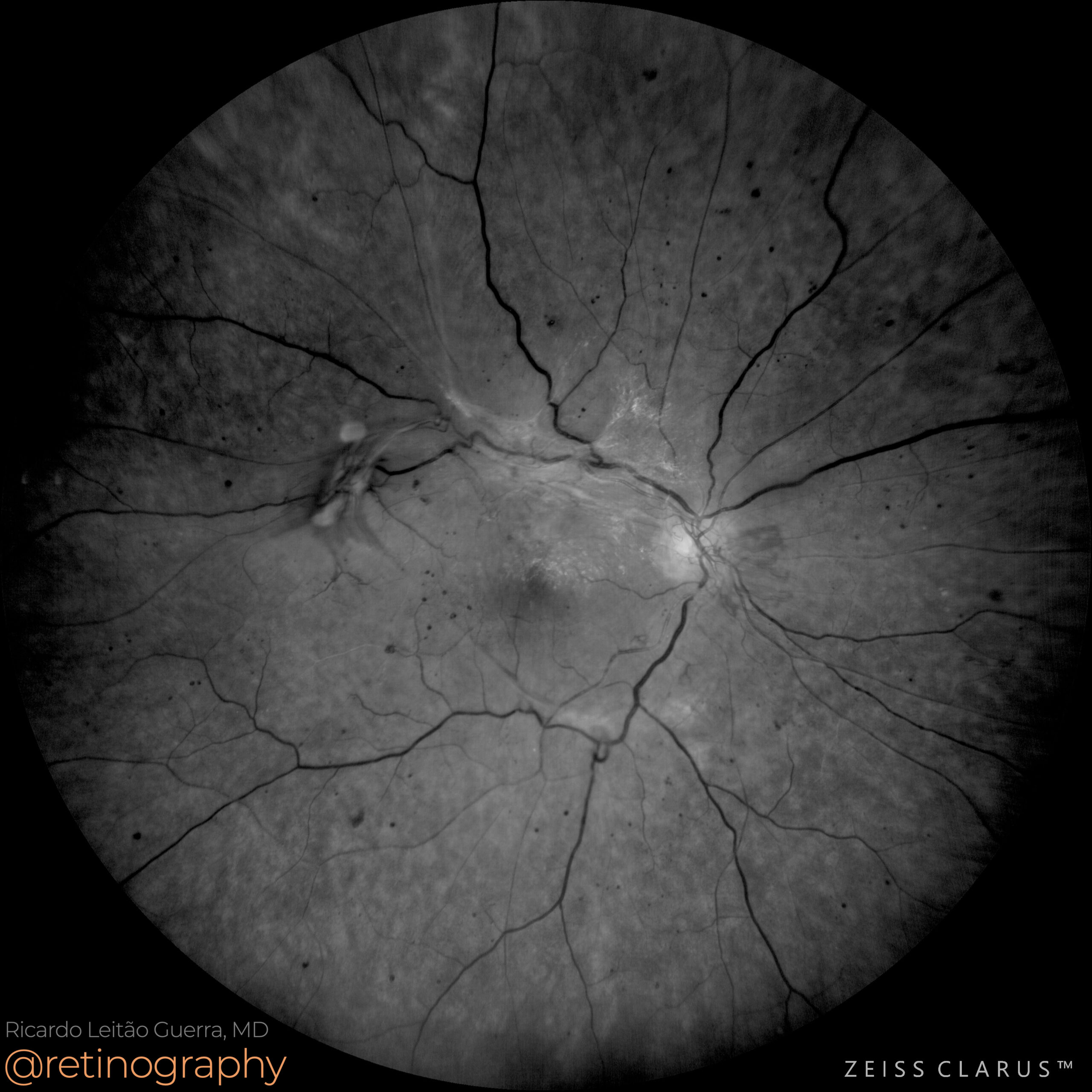 PDR: Tractional retinal detachment – Retinography