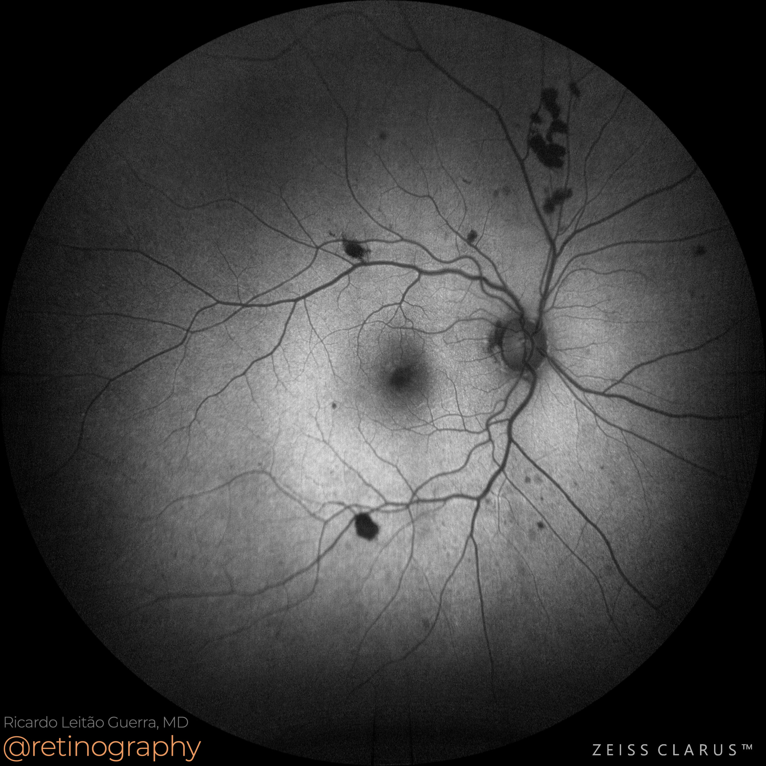 ERM: Diabetic retinopathy – Retinography
