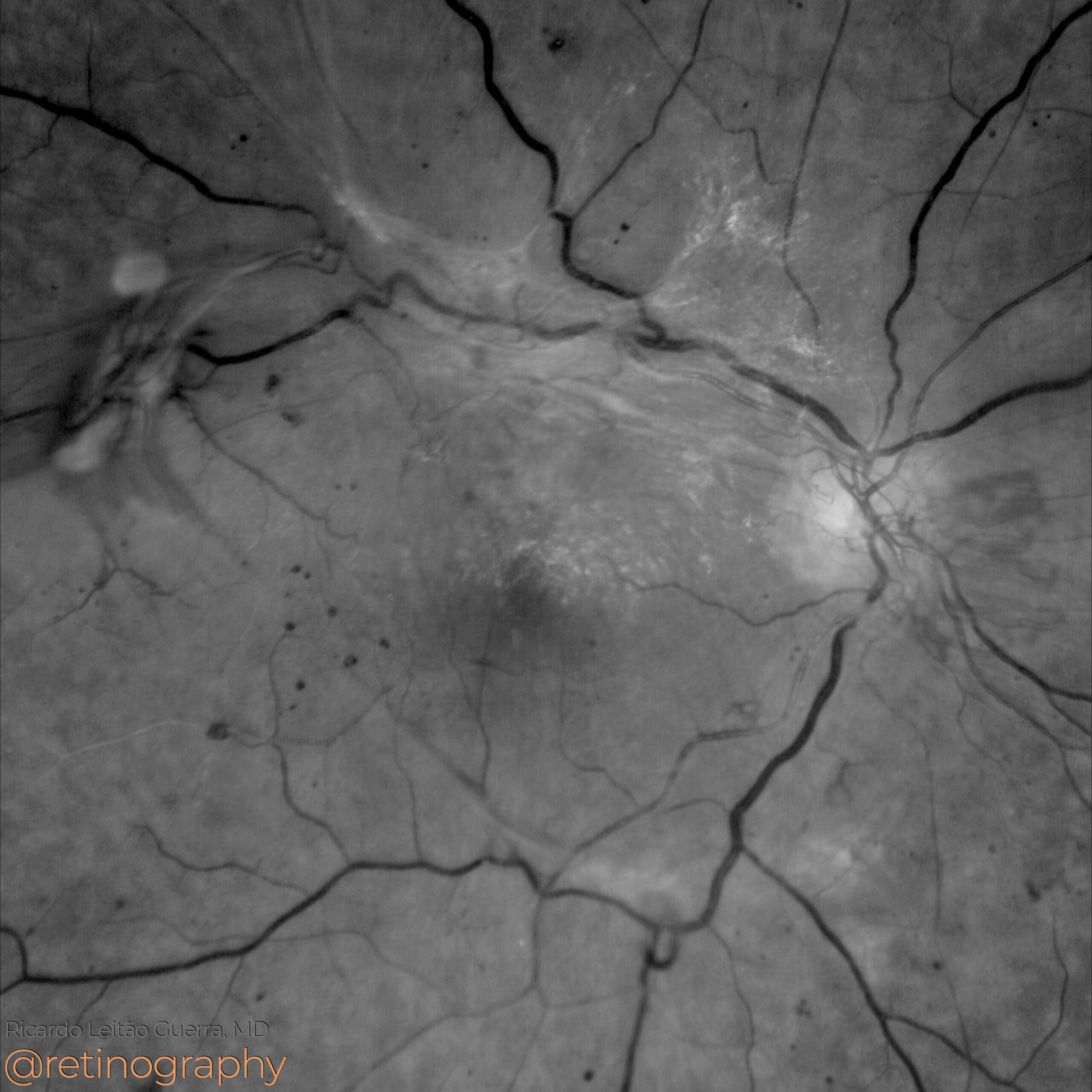 PDR: Tractional retinal detachment – Retinography