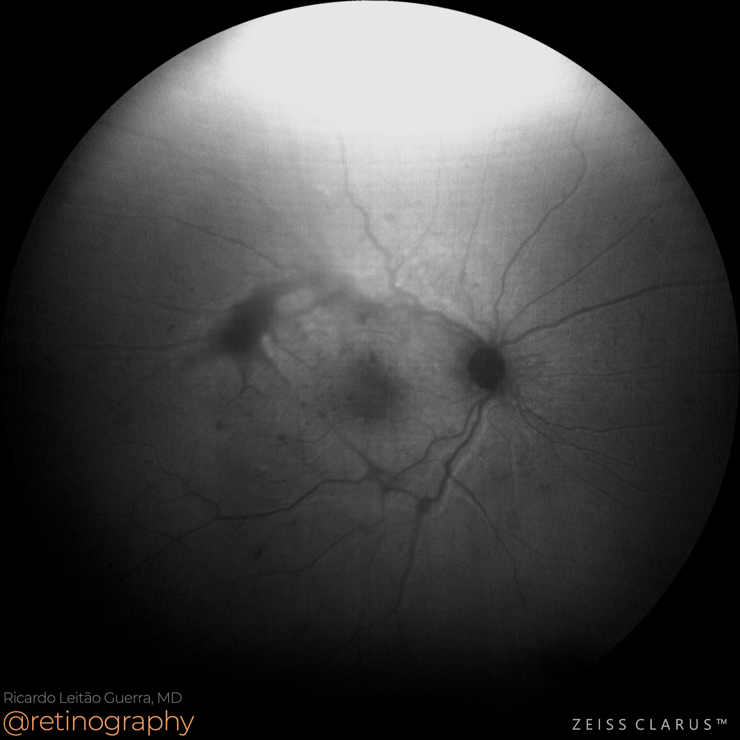 PDR: Tractional retinal detachment – Retinography