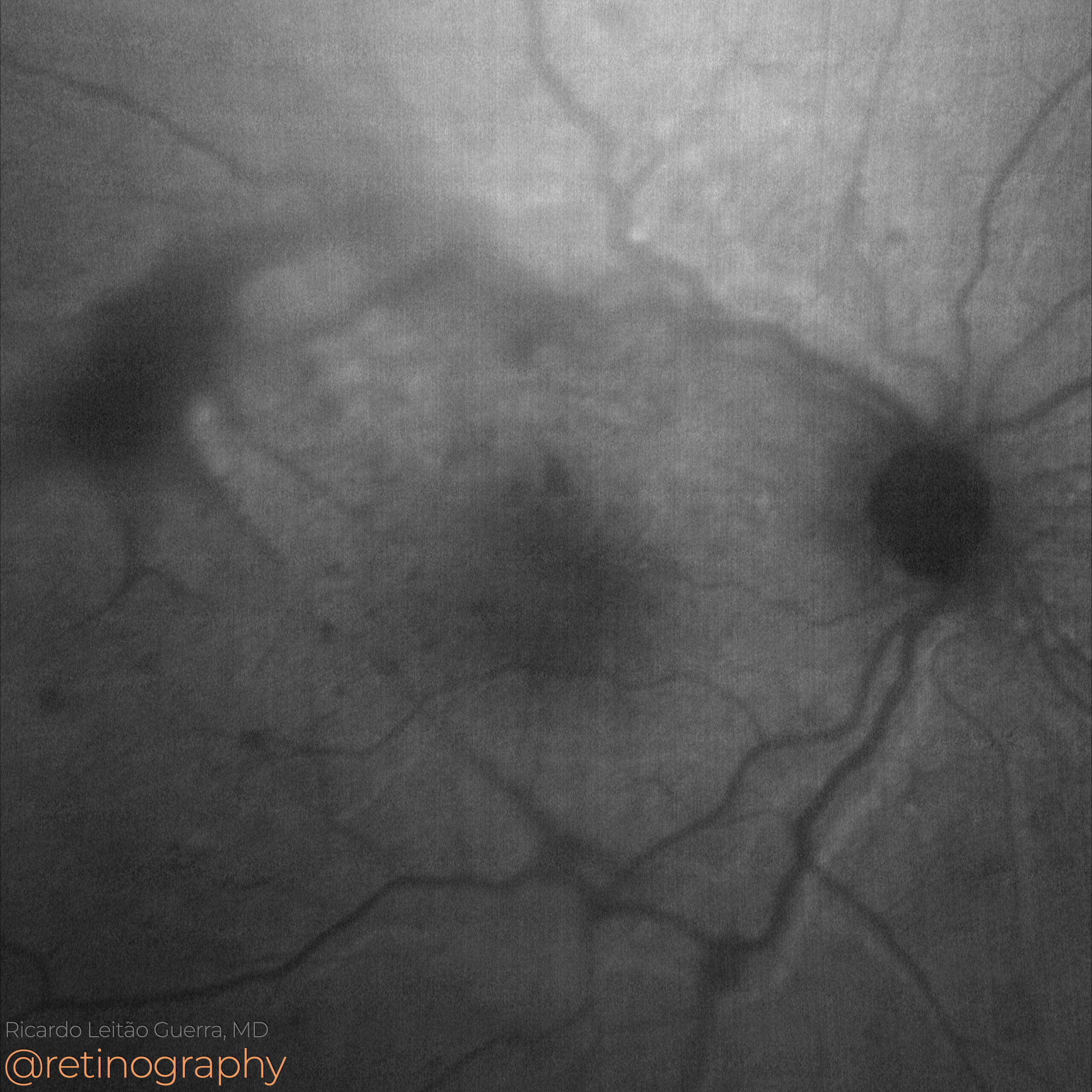 PDR: Tractional retinal detachment – Retinography