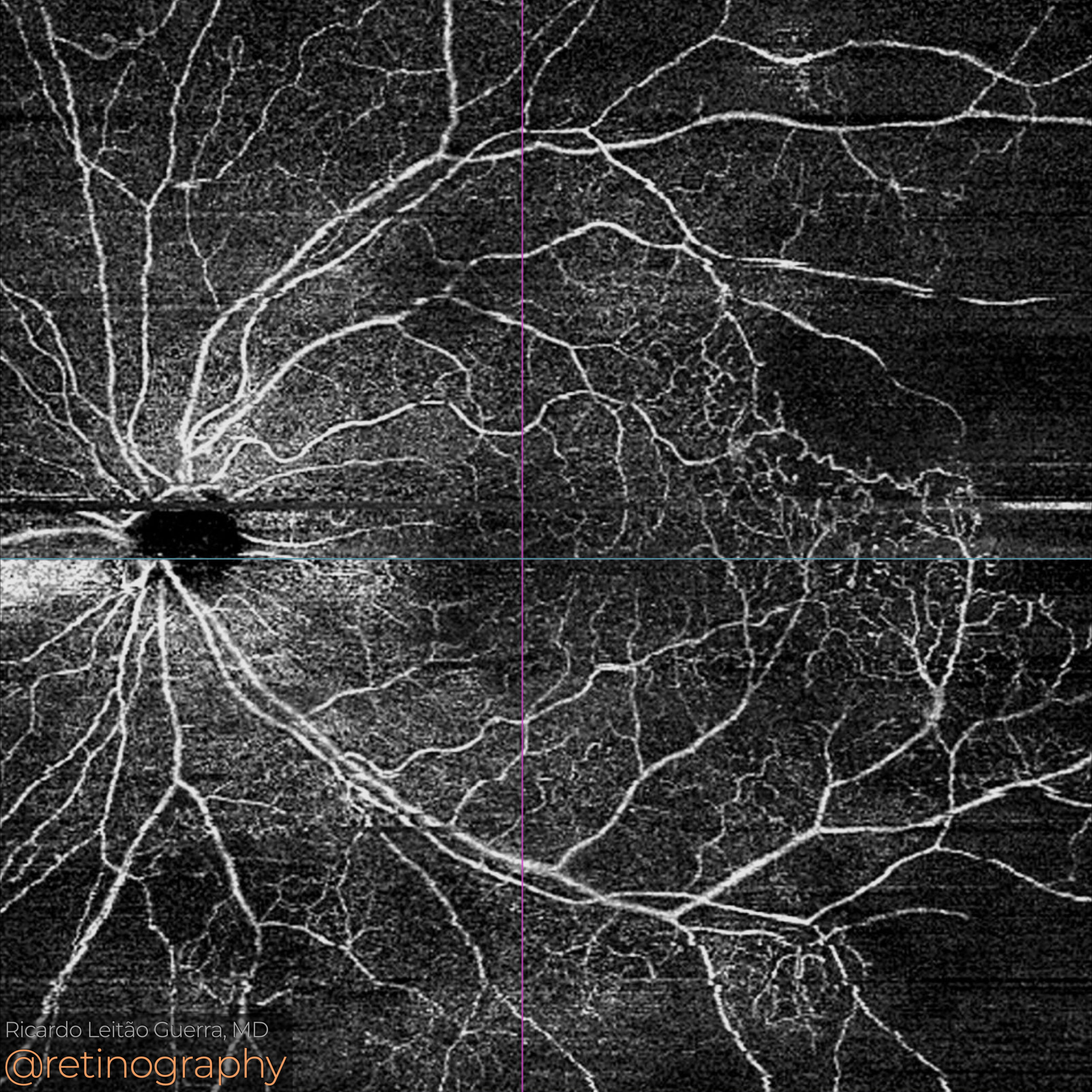 Diabetic retinopathy: Nonperfusion – Retinography