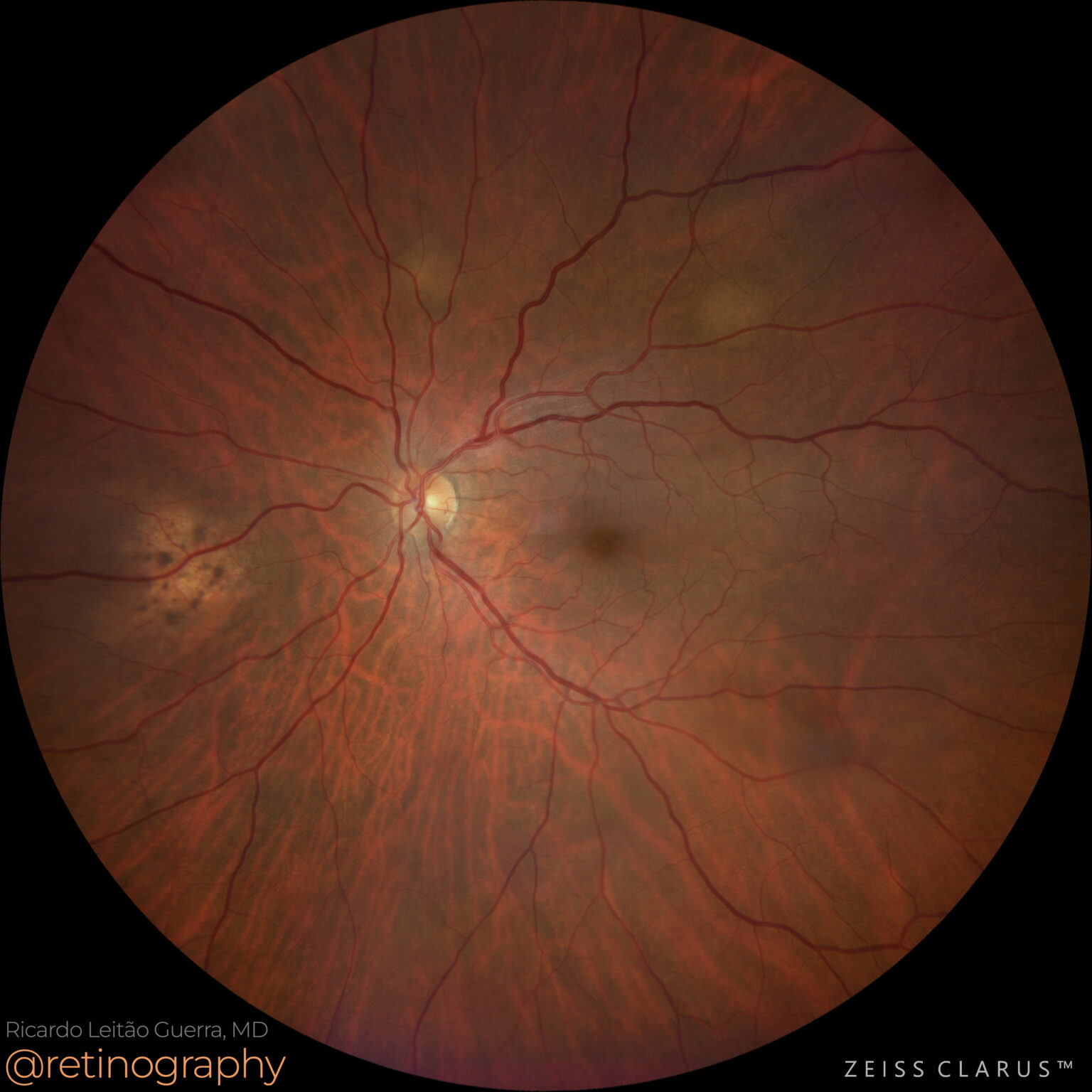 Choroidal Metastases – Retinography