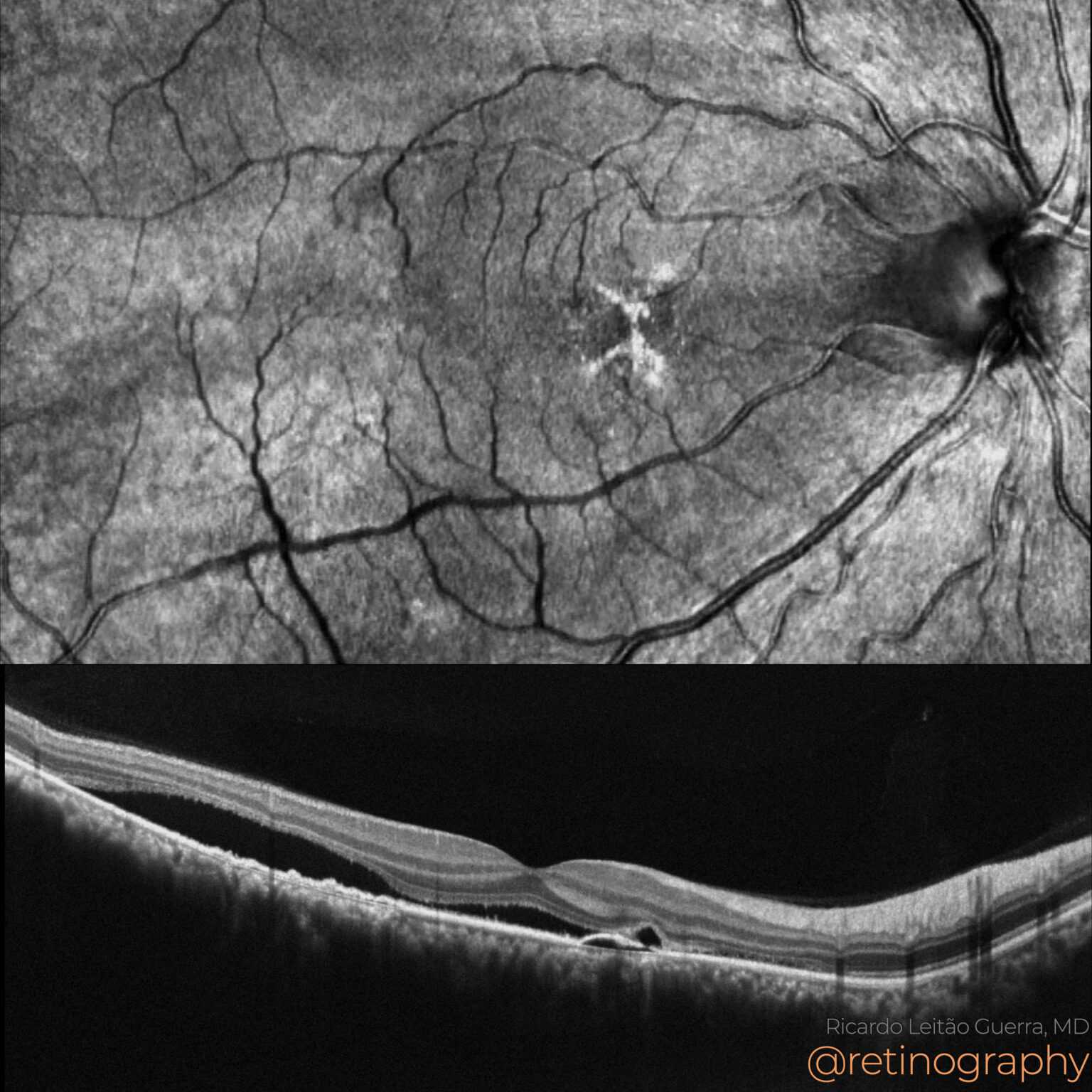 Central Serous Chorioretinopathy – Retinography
