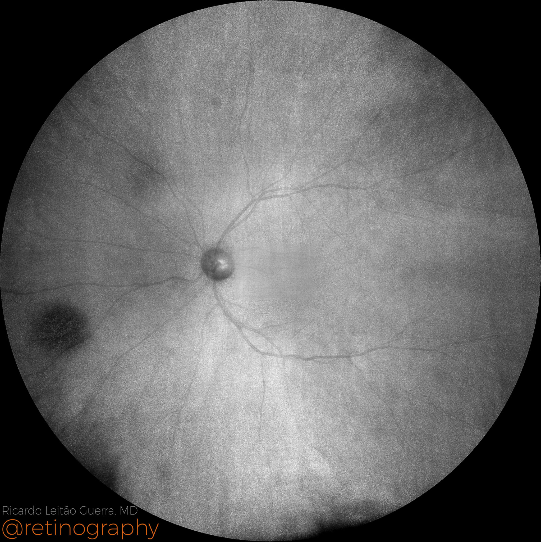 Choroidal nevus – Retinography